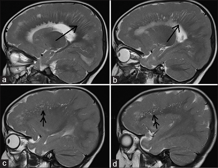 Technical Info on Pachygyria and Lissencephaly Levels – Making ...